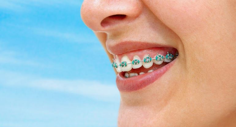 How Much Do Braces Cost in California A Detailed Breakdown Amal Ramlaoui DDS